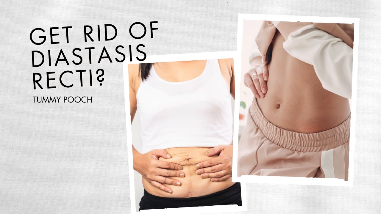 What is Diastasis Recti? | Tummy Muscle Separation After Pregnancy ...