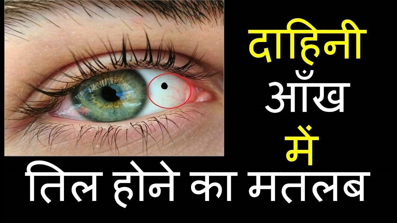 दाहिनी आँख में तिल होने का मतलब । Moles in right eye and its meaning ...