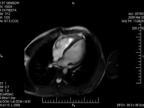 Cardiología HU - Resonancia Magnética Cardiaca (Normal) - YouTube