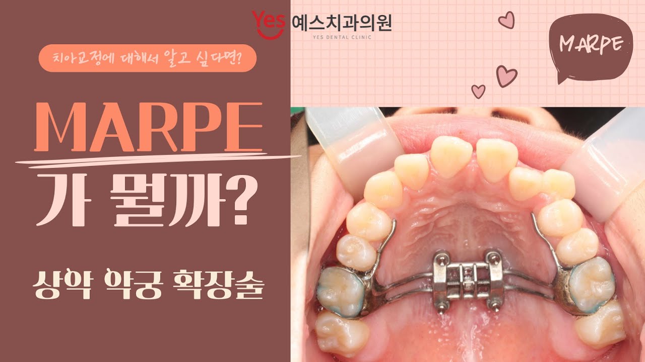 얼굴비대칭과 주걱턱으로 위턱을 넓히는 말페 MARPE 상악확장술 💕부산치아교정 서면예스치과 💕 - YouTube