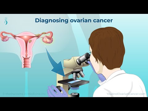 Diagnosing Ovarian Cancer