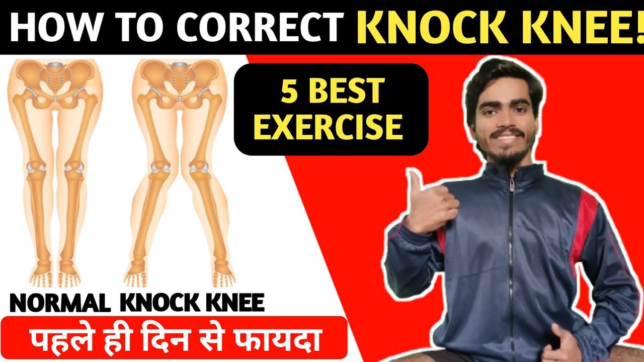 HOW TO CORRECT KNOCK KNEE|| KNOCK KNEE कैसे ठीक करें||BEST EXERCISE FOR ...