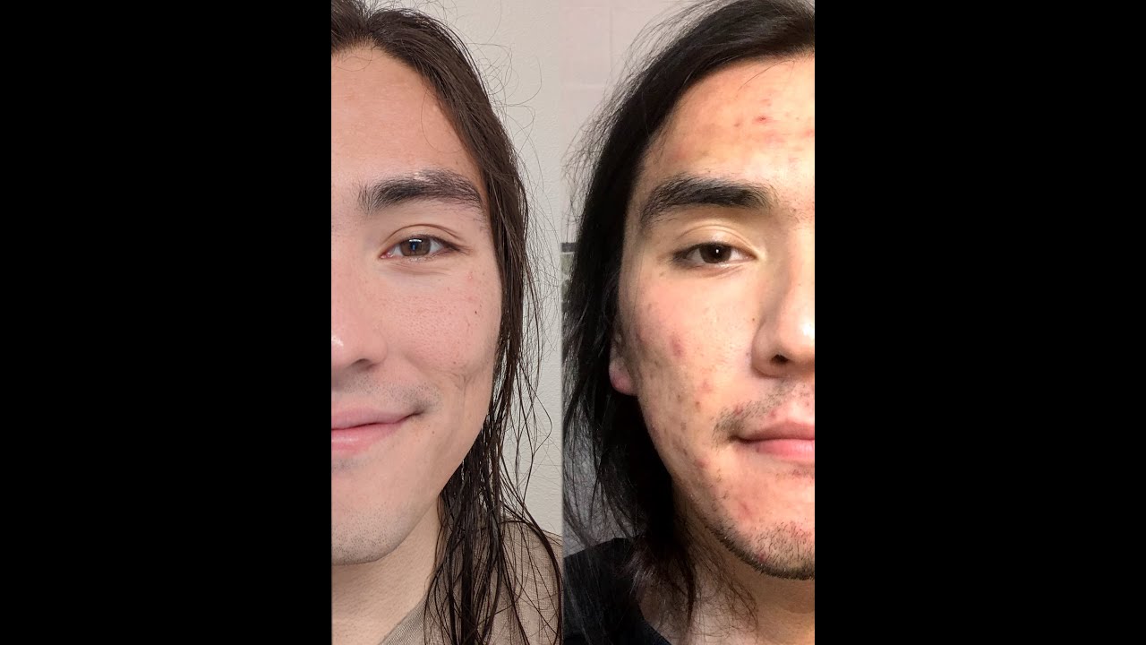 Accutane Transformation Timelapse #shorts - YouTube