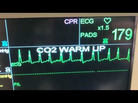 ZOLL R Series Cardioversion - YouTube