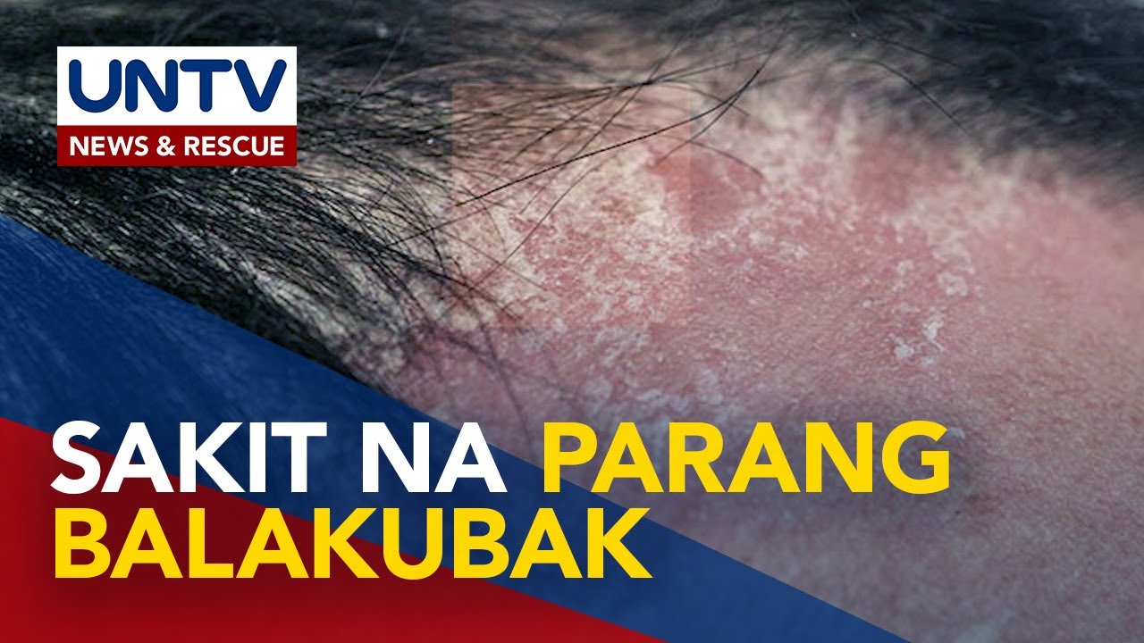 ALAMIN: Makati, masakit at makapal na balat na tila dandruff, sintomas ...