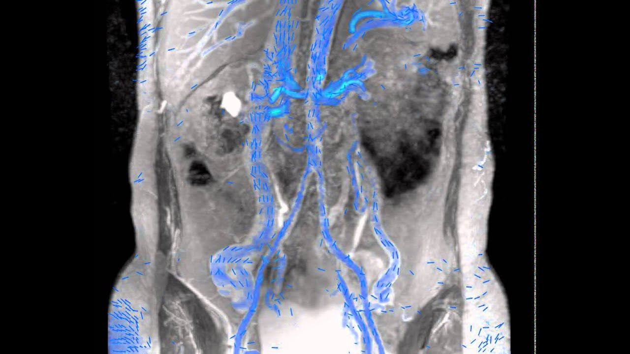 Ovarian vein collaterals - YouTube