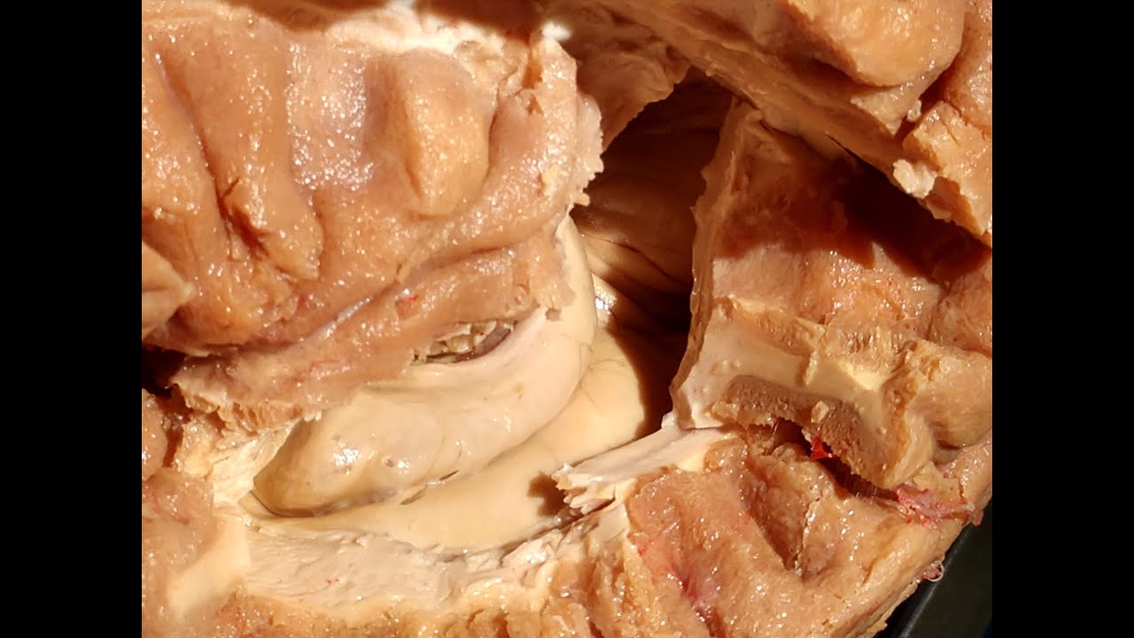 Anatomia do lobo temporal aplicada a cirurgia da epilepsia - Dr. Bruno ...