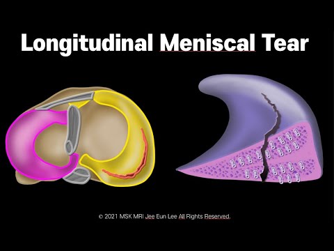 [Tear_03] Longitudinal Meniscal Tear -01 - YouTube