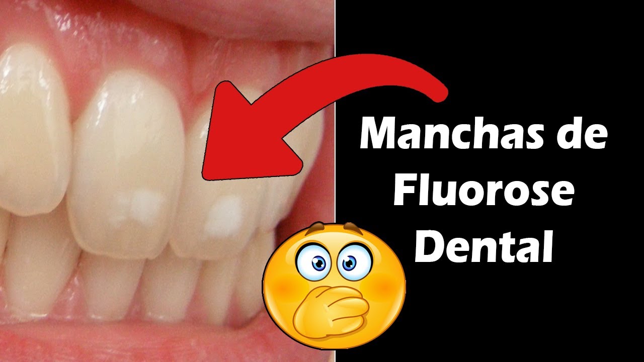 Será que o Flúor Faz Mal? – Benefícios e Malefícios do Flúor – Glândula ...