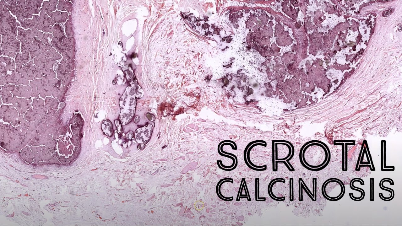 Scrotal calcinosis (calcinosis cutis of scrotum) pathology dermpath ...