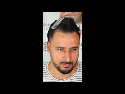 L’expérience de greffe capillaire du footballeur professionnel Nacer Chadli