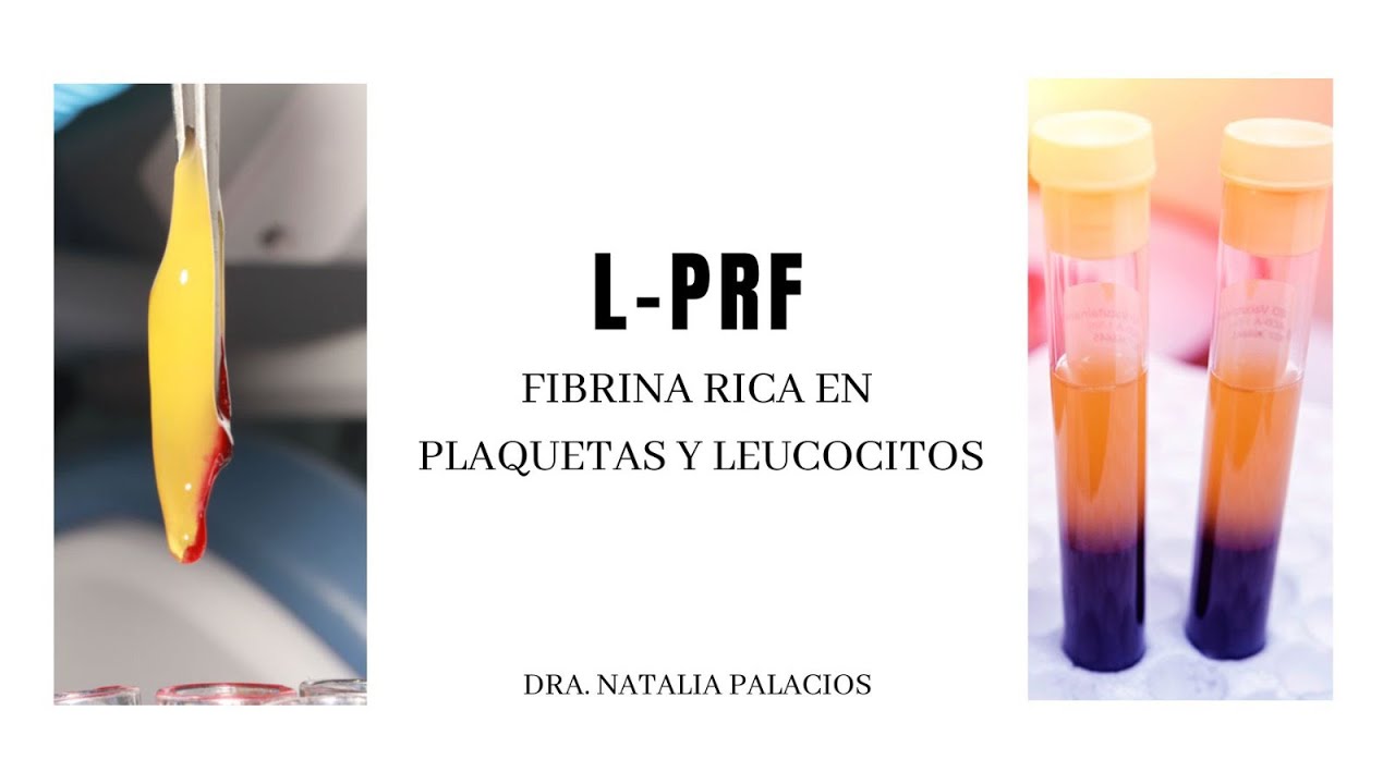 L-PRF: Fibrina Rica en Plaquetas y Leucocitos - YouTube