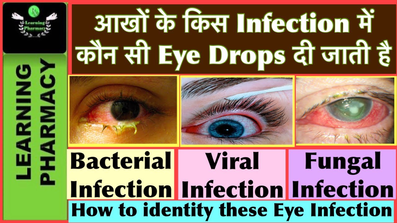 Different Eye Infections & their treatment || What kind of infection ...