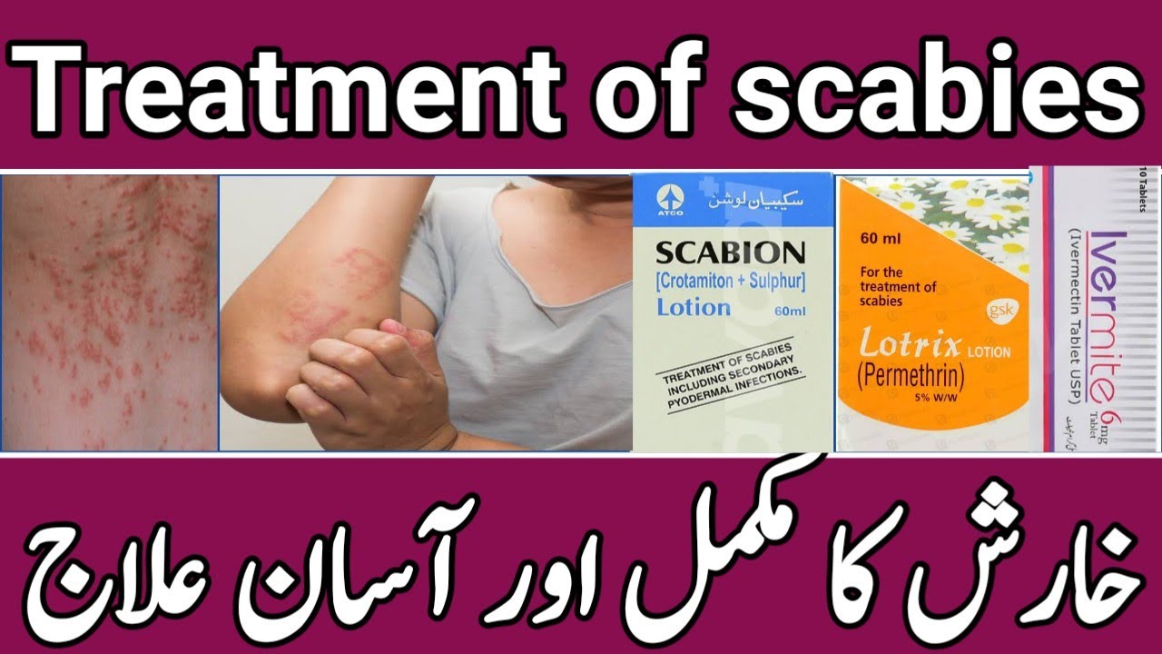 kharish ka ilaj|kharish khatam karne ka tarika| scabies treatment at ...