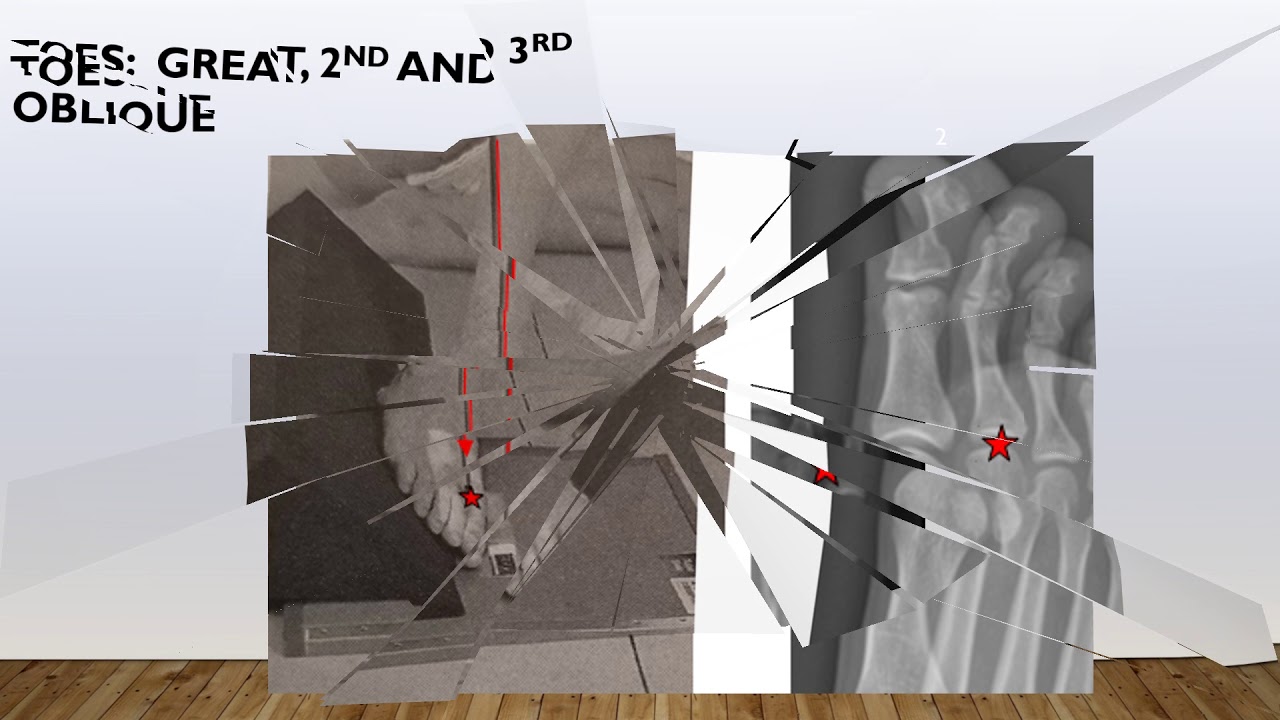 Radiographic Lower Extremity Positioning - YouTube