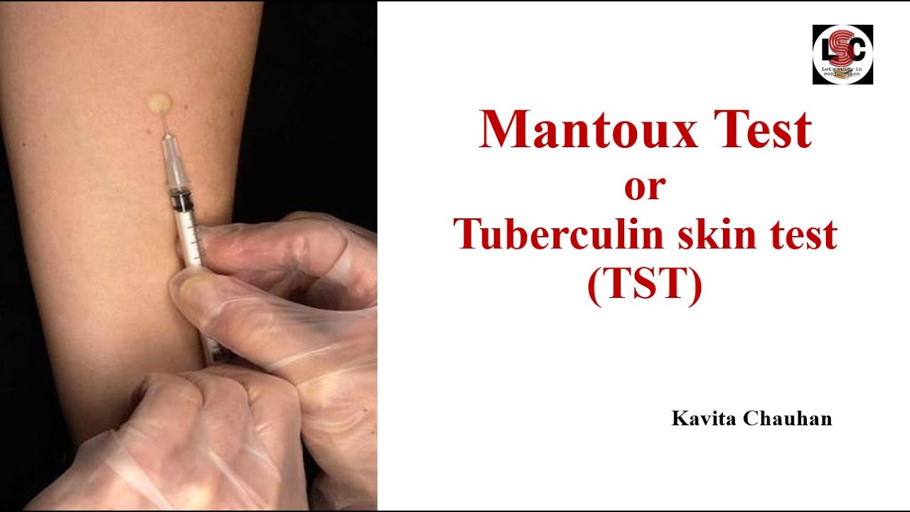 Mantoux Test | Tuberculin Skin Test | Purpose | procedure | Result ...