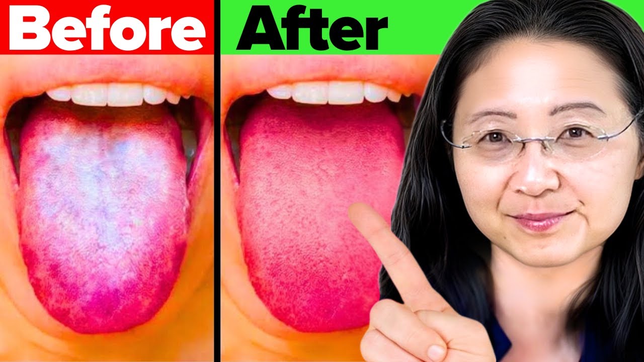 Candida: Top 10 Foods To Rid Overgrowth! - YouTube