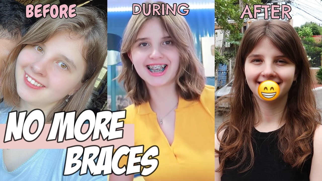 Getting My Braces Off After 16 Months! - YouTube