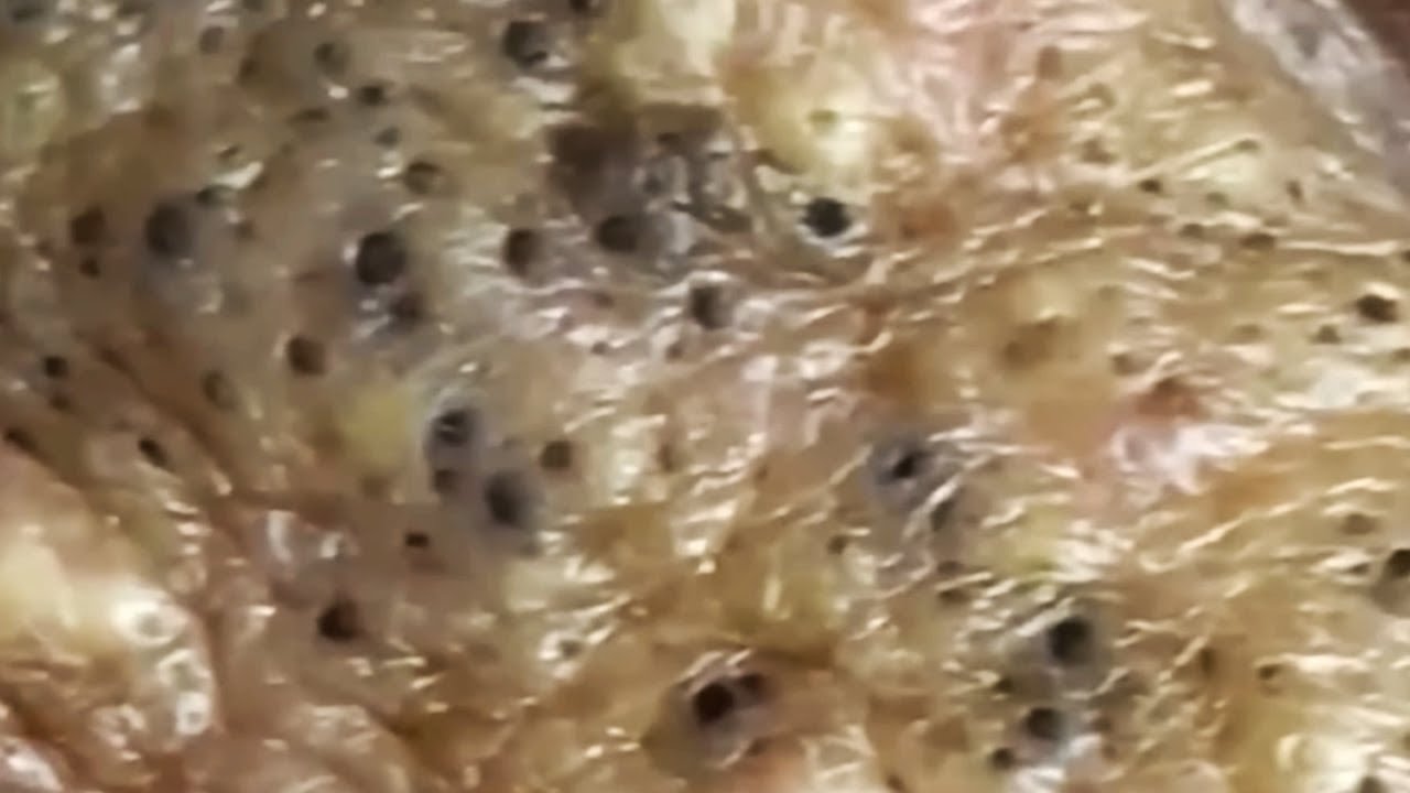 Satisfying Acne and Pimple Removal Blackheads & Whiteheads #1234 - YouTube