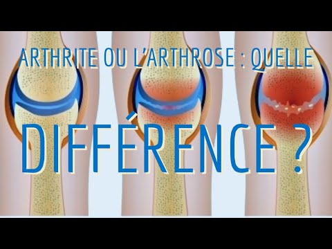 Quelle est la différence entre l'arthrose et l'arthrite ? - YouTube