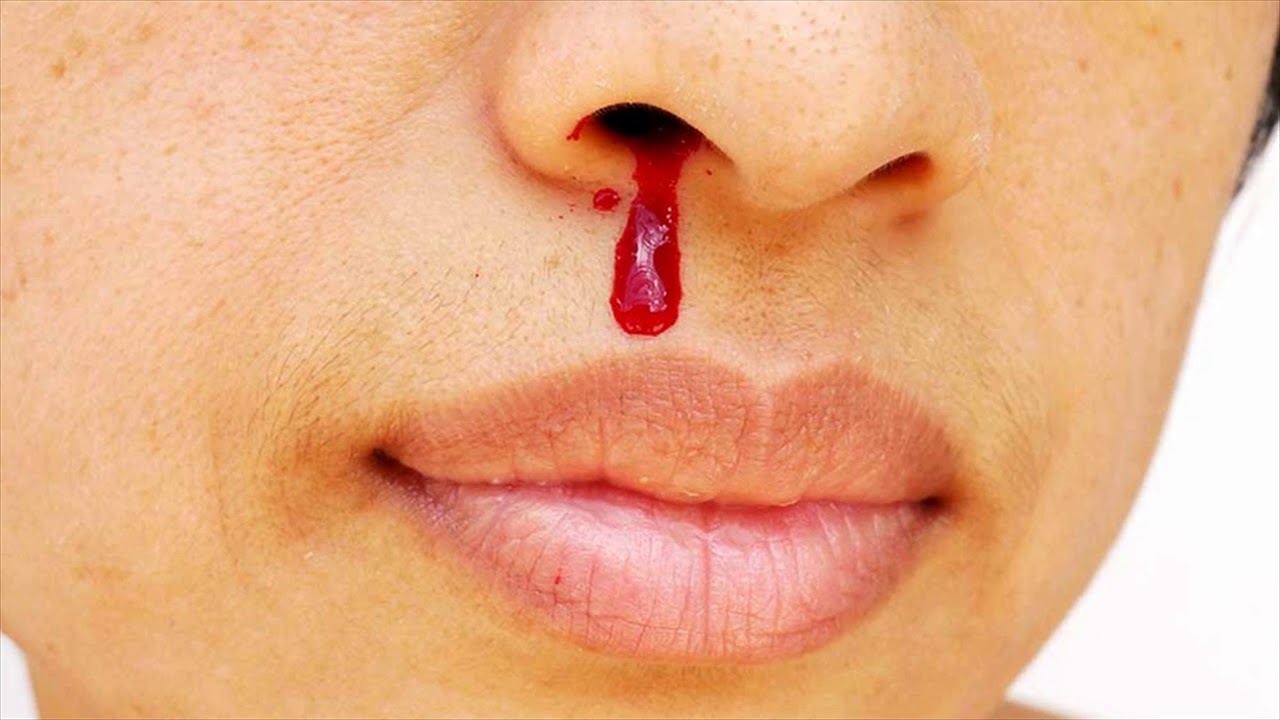 How Do You Prevent The Nose From Bleeding Again- Nose Bleeding ...