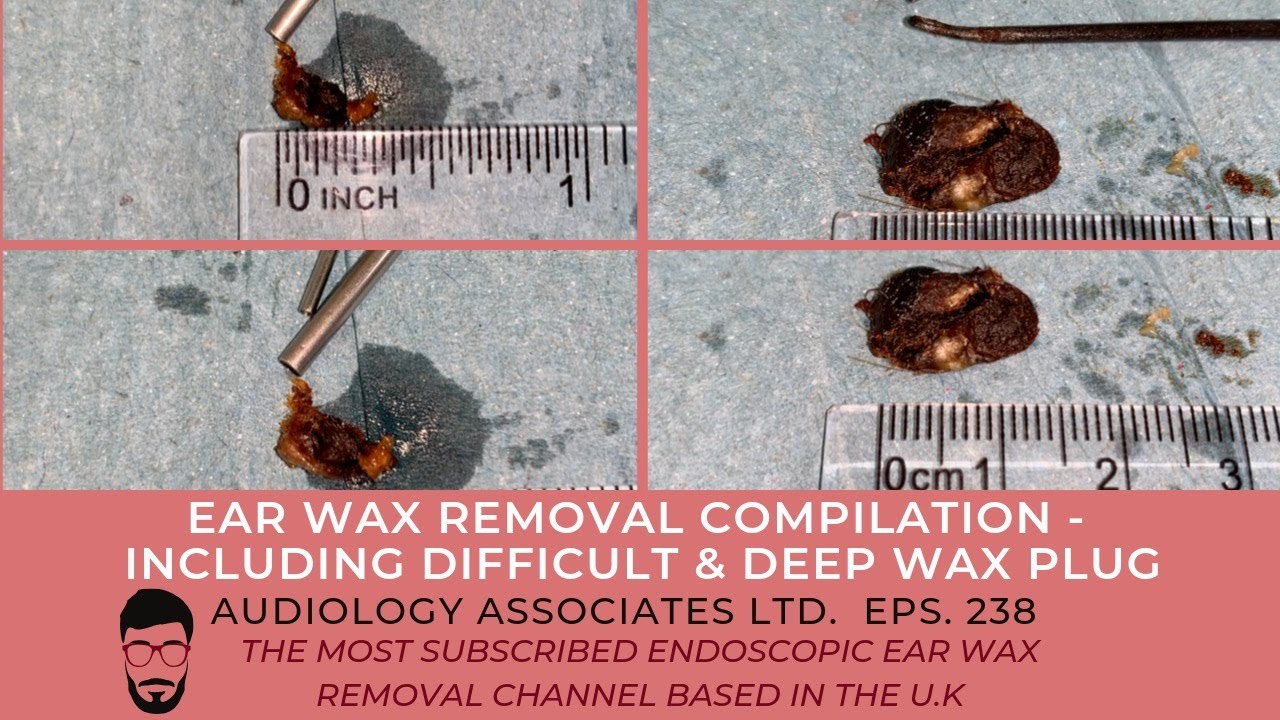 EAR WAX REMOVAL COMPILATION - INC DIFFICULT DEEP WAX PLUG - EP 238 ...