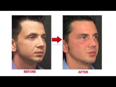 Face Fitness Formula Before and After - YouTube