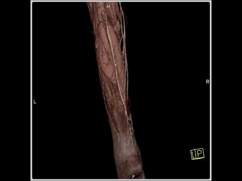 Vascular: CT angiography of the lower extremity(1 of 3) - YouTube