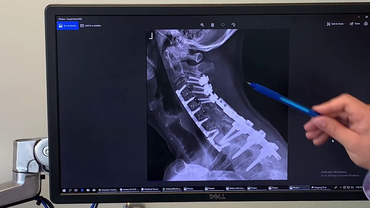 Text neck or computer neck syndrome - YouTube