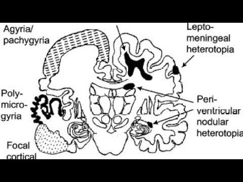 Neuronal Migration Disorders - YouTube