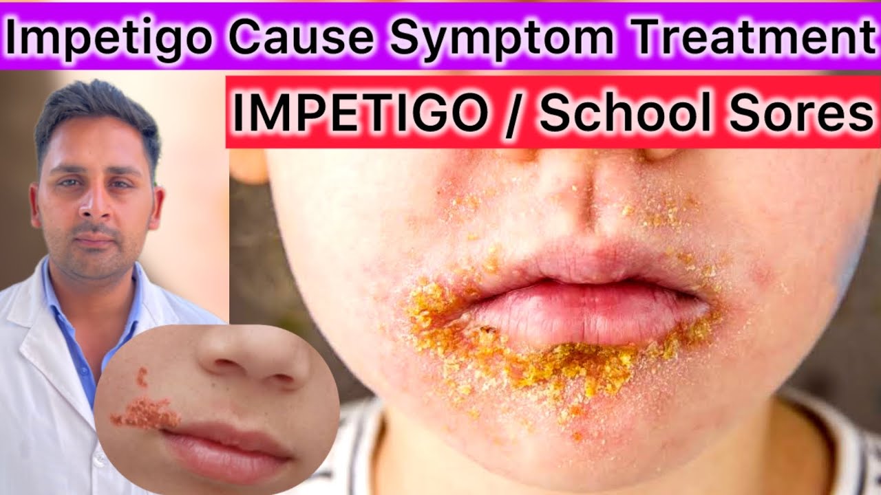 Impetigo Cause Symptoms Diagnose Treatment In Hindi || IMPETIGO ...