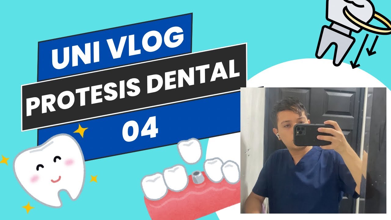 UNI VLOG: Prótesis dental, enmuflado, puente veneer combinado, puente ...