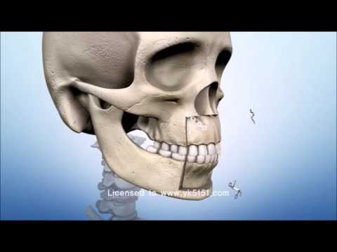 ASO, Anterior Segmental Osteotomy, Bimaxillary protrusion, bird face ...