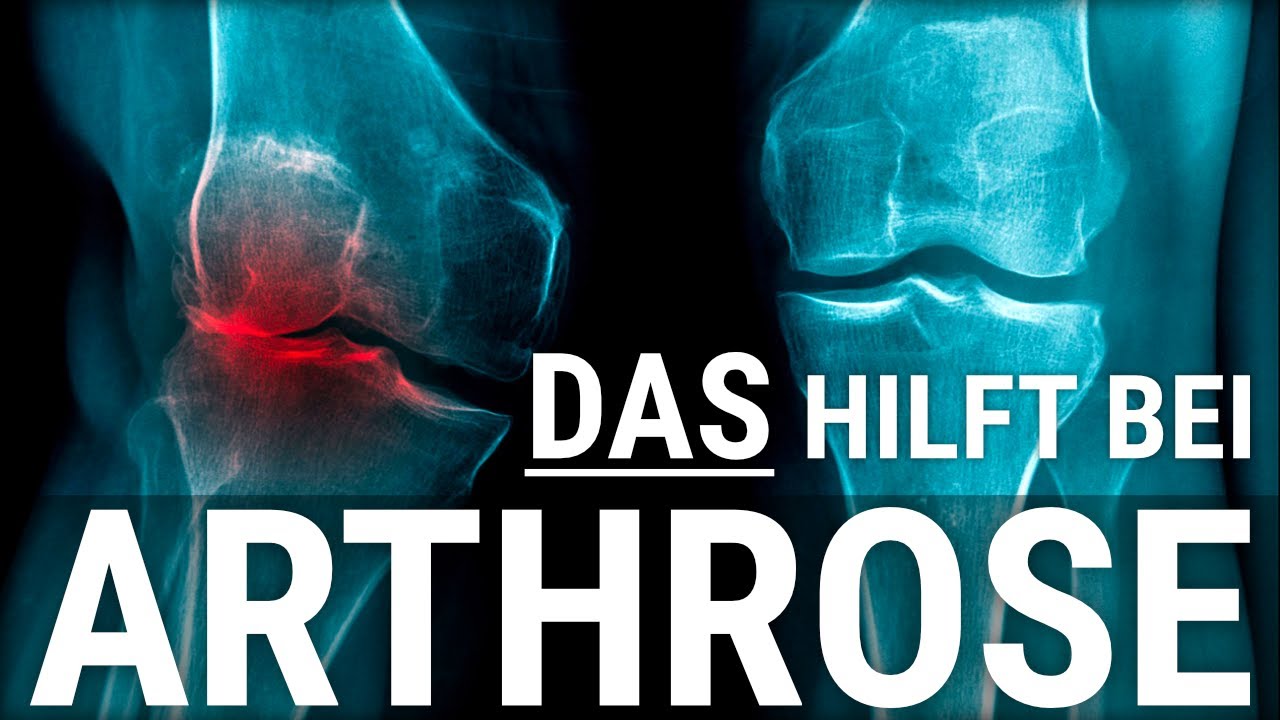 5 Tipps bei ARTHROSE (Omarthrose, Spondylarthrose, Rhizarthrose ...