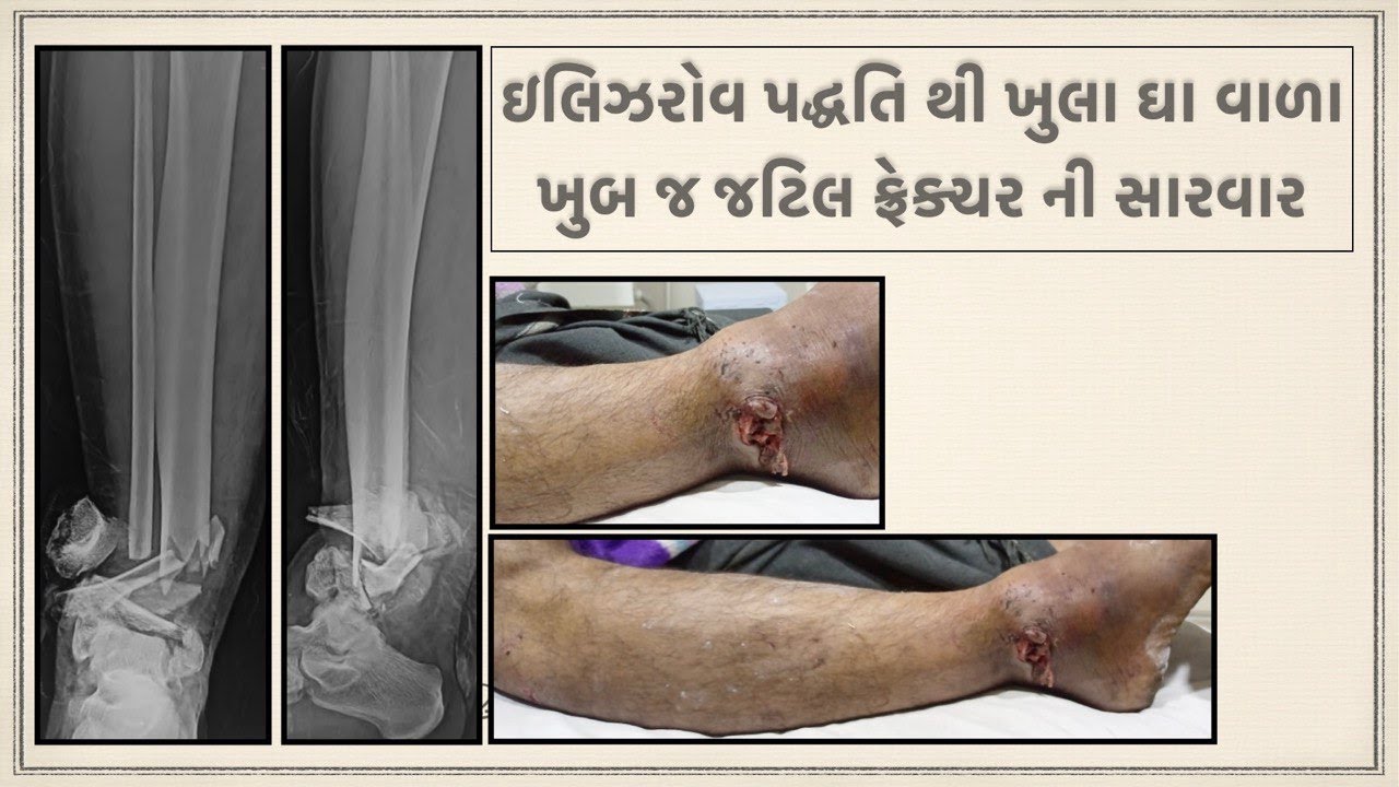Management of Open Grade II Comminuted Fracture Distal Tibia and Fibula ...