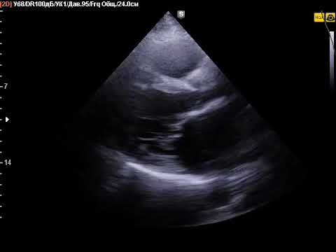 Rupture of chordae tendineae - YouTube