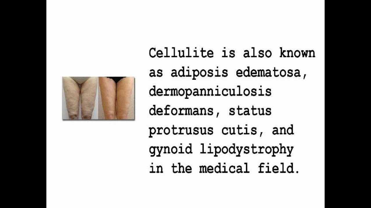 Mischa Barton Cellulite - YouTube