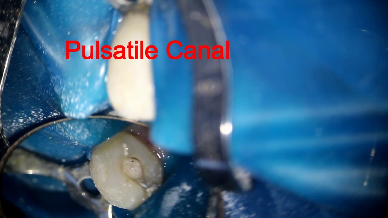 pulsatile canall - YouTube