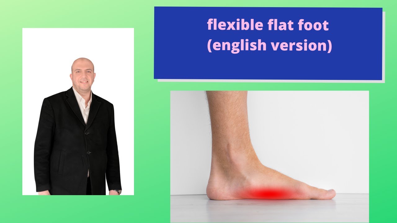 flexible flat foot (english version) - YouTube