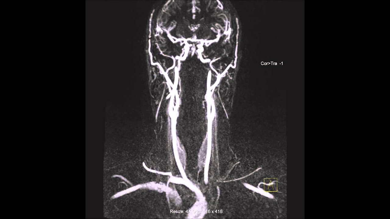 Servikal Anjio - YouTube