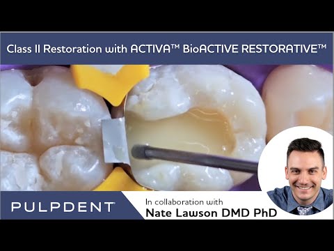Class II Restoration with ACTIVA™ BioACTIVE RESTORATIVE™ - YouTube