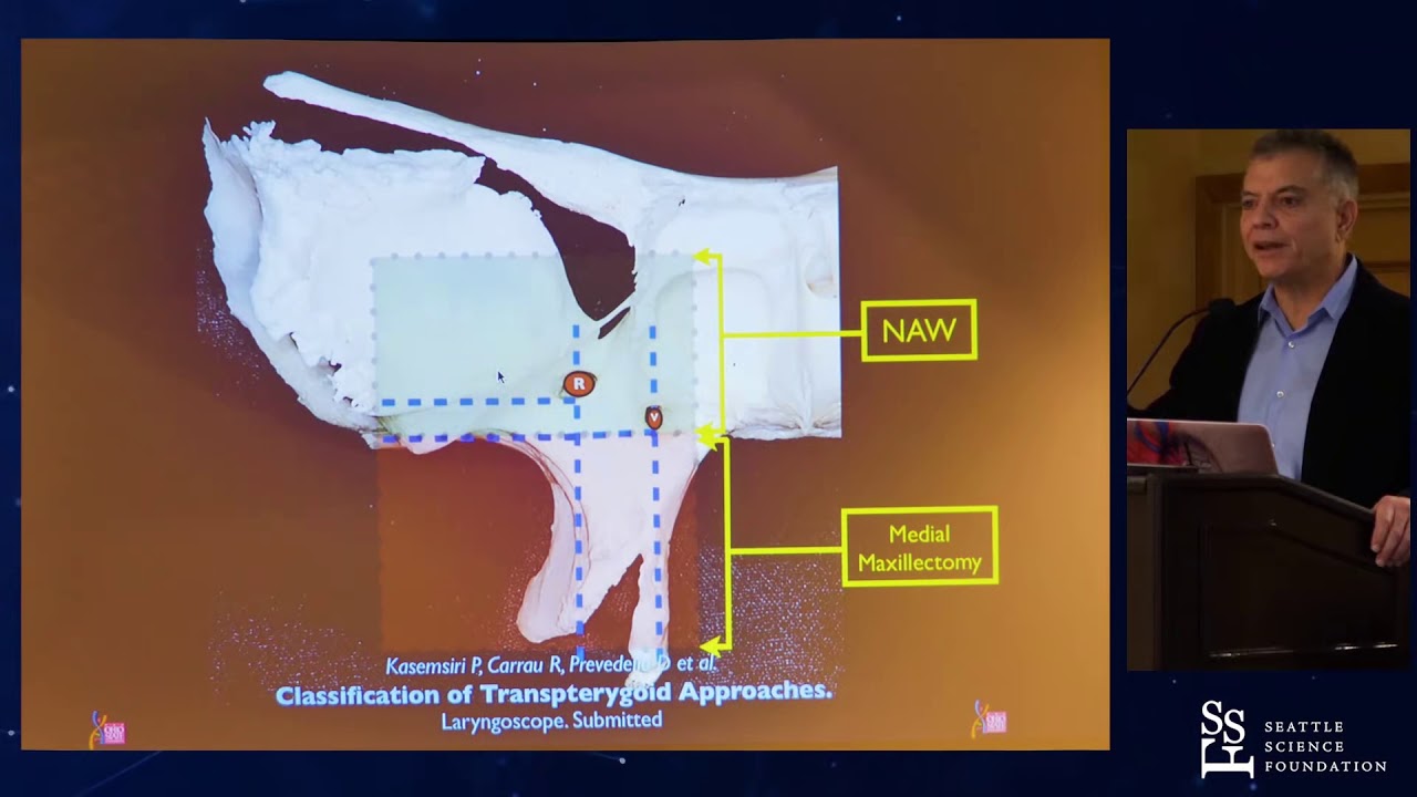Endoscopic Transpterygoid Approach - Ricardo Carrau, MD - YouTube