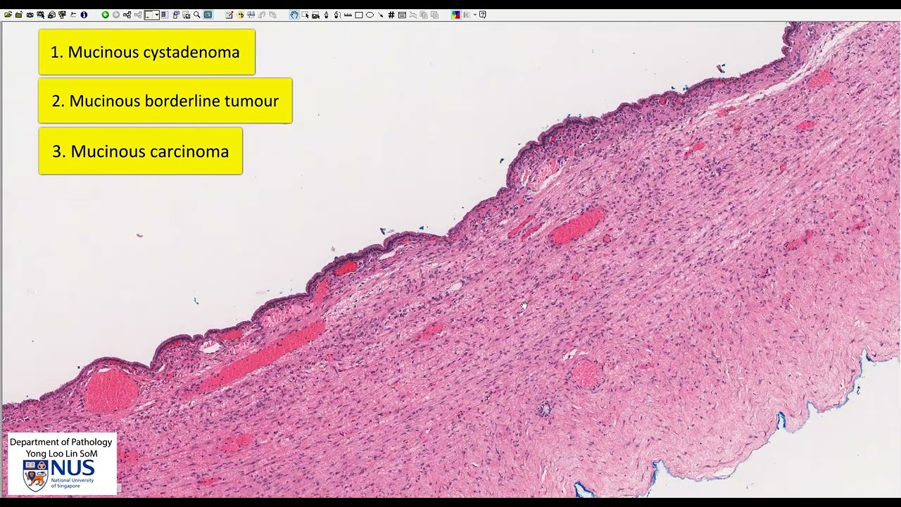 Mucinous Cystadenoma Pancreas Histology
