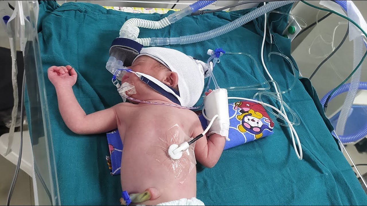 cpap support🙏🙏baby 🙌 - YouTube