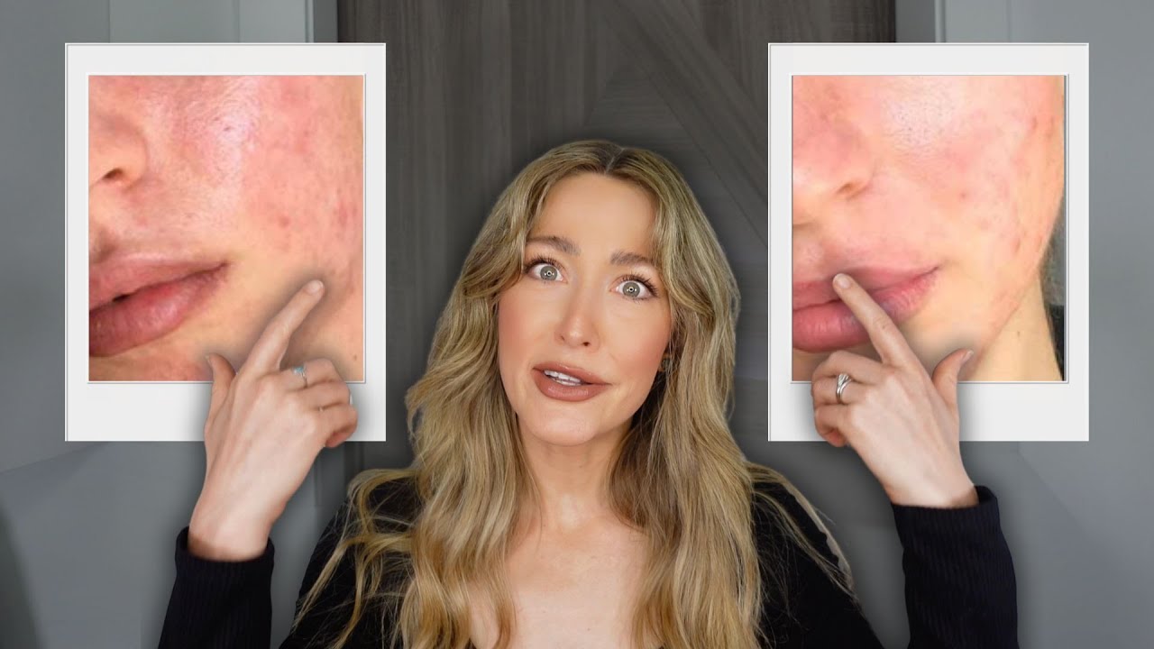 How I Healed My Acne Scars & Boosted Collagen - YouTube
