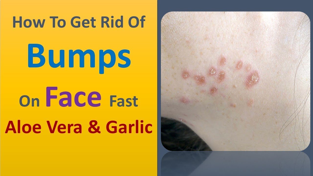 How To Get Rid Of Bumps On Face Fast Aloe Vera Garlic YouTube how-to-get-rid-of-bumps-on-face-fast-aloe-vera-garlic-youtube