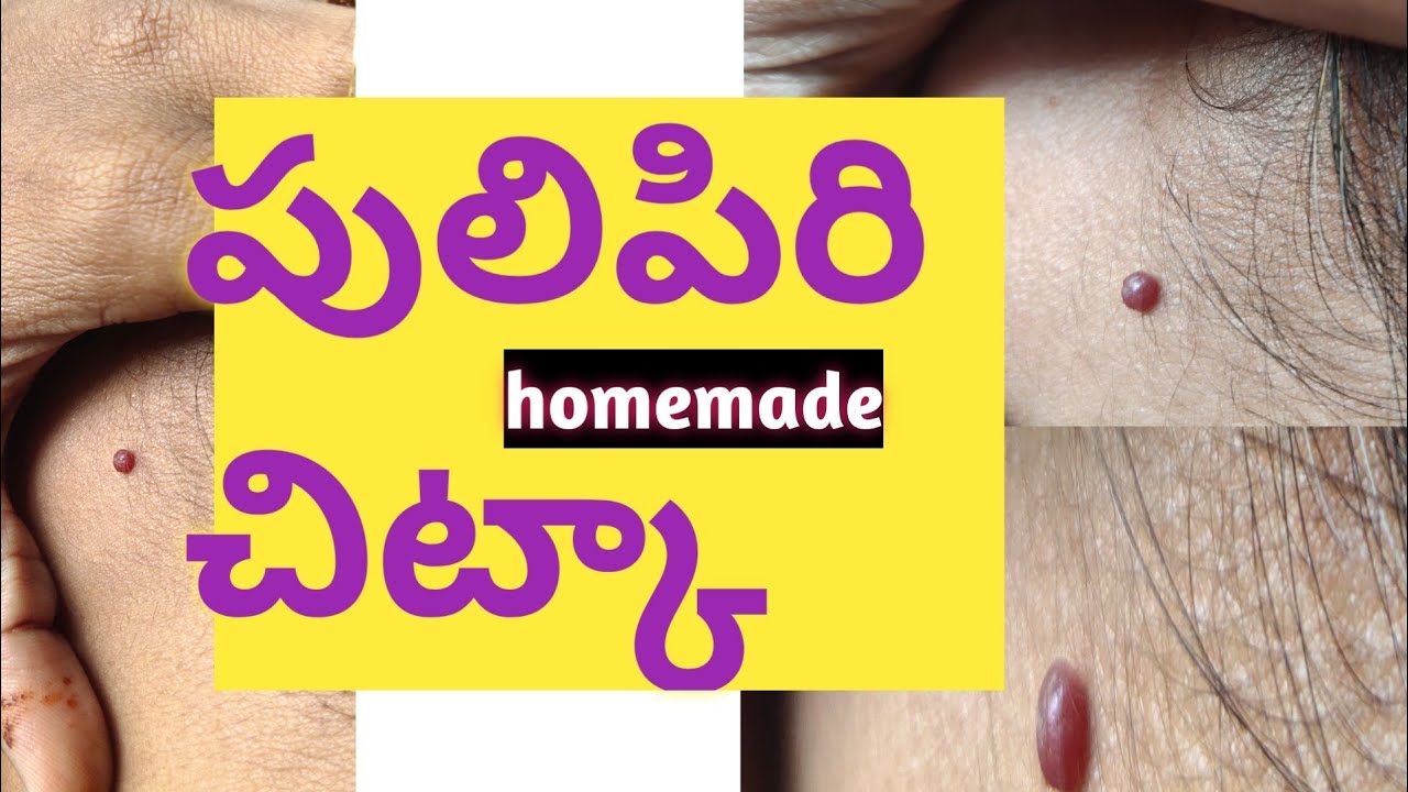 HowTo Remove Pulipirlu At Home In Telugu 2021/How To Remove Skin Tags ...