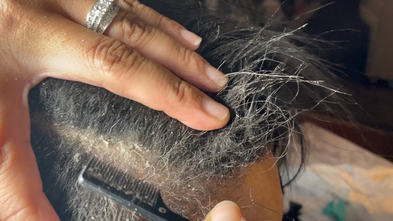 Late Night Dandruff Scratching | Back of Head PT. 2 - YouTube