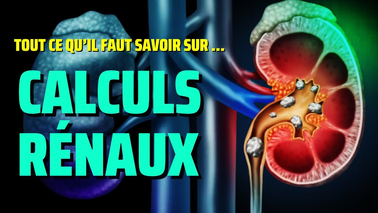 Calculs rénaux et Coliques néphrétiques : causes, symptômes ...