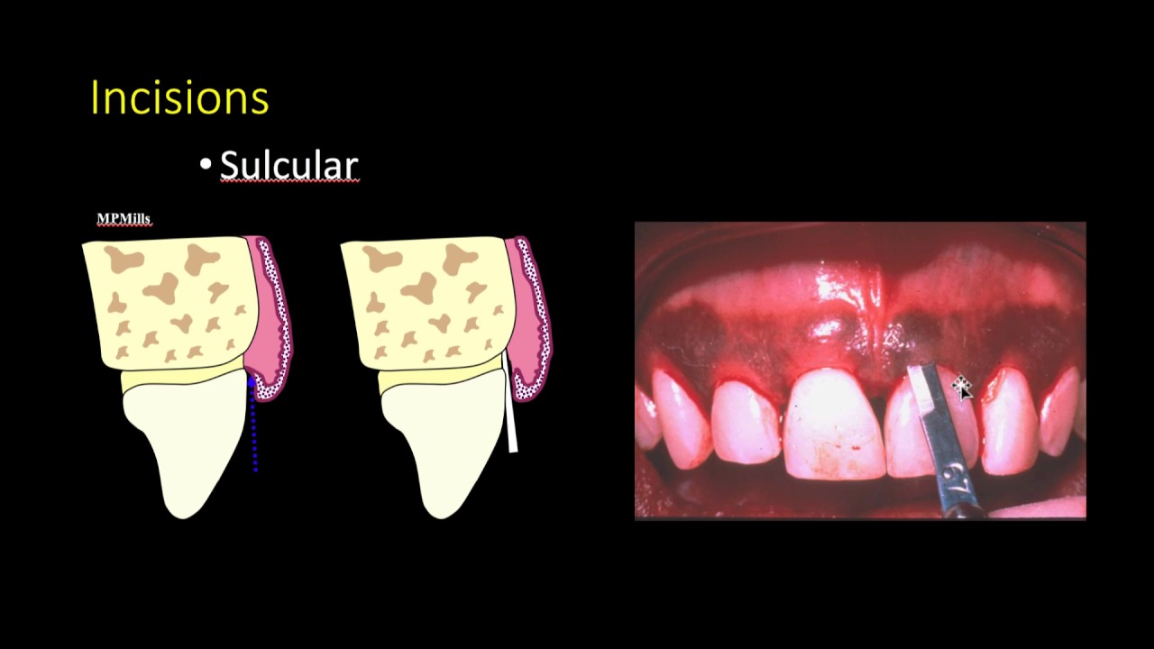 Module 3 - Incisions - YouTube